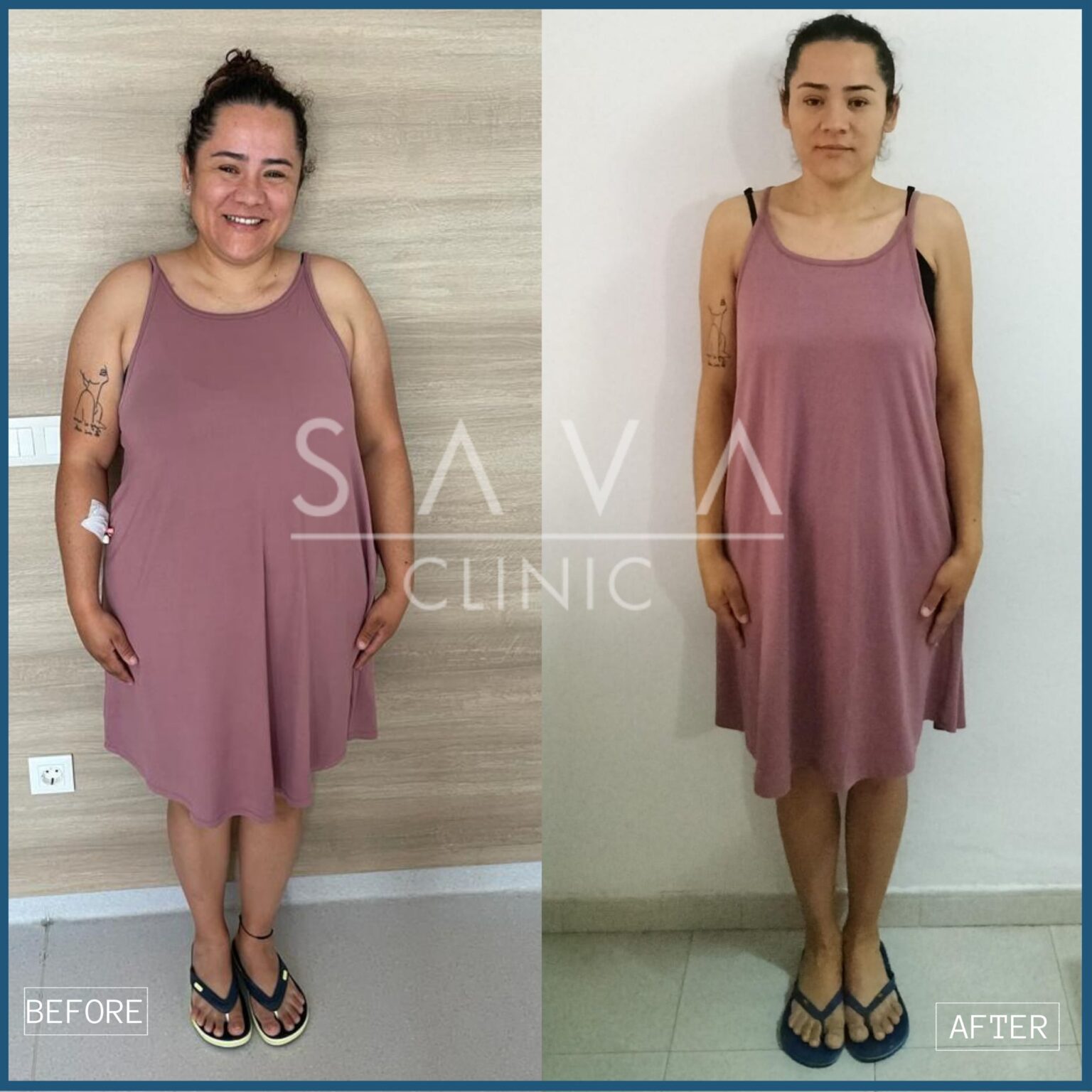 Avant Après - Sava Clinic